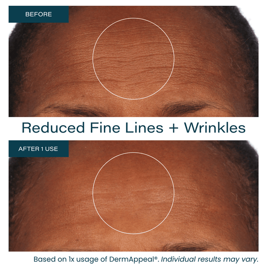 DermAppeal® Microdermabrasion Treatment - At-Home Exfoliant – SKINN